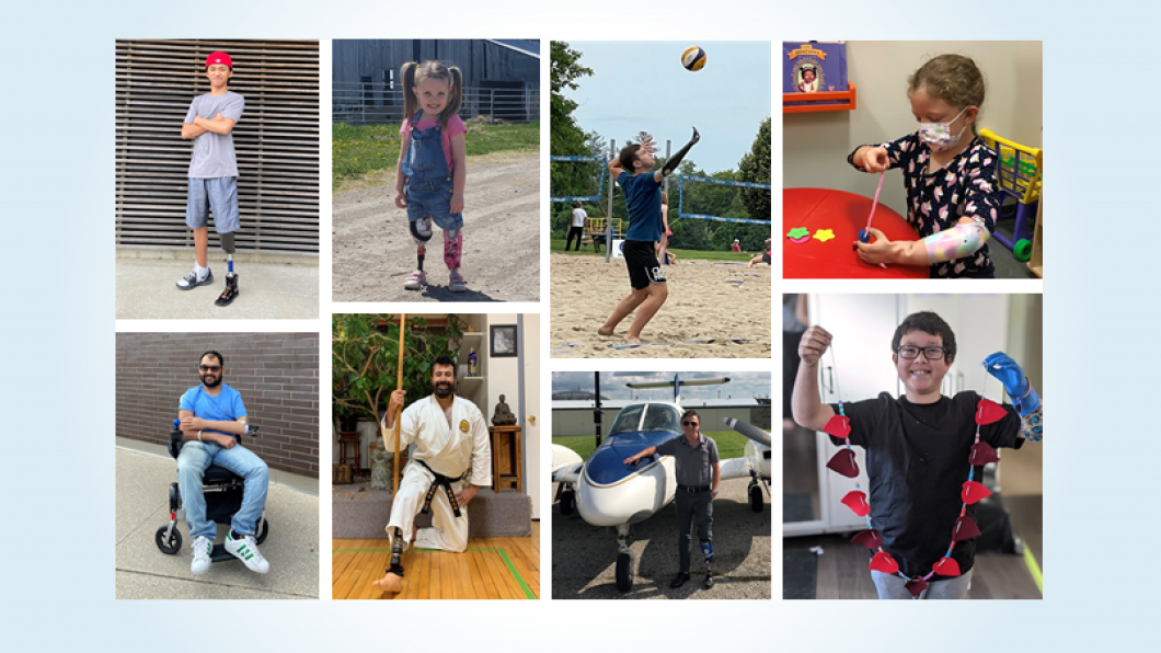 Prosthetics and Myoelectrics | Holland Bloorview